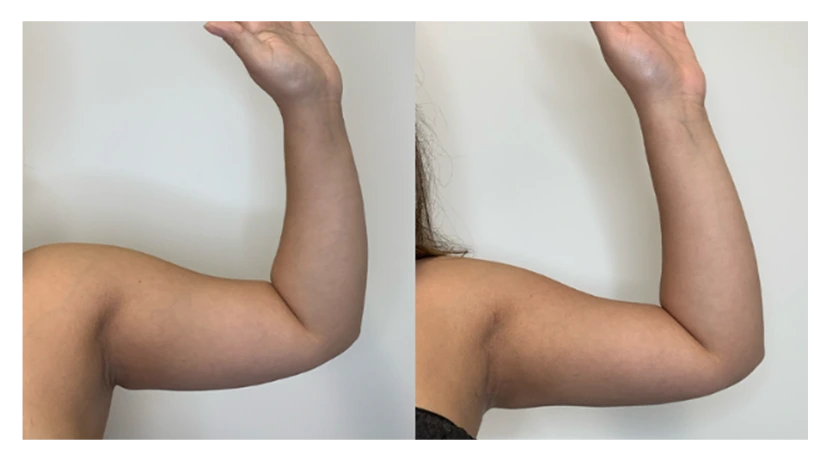 Minimally Invasive Arm Liposuction in Scottsdale, AZ